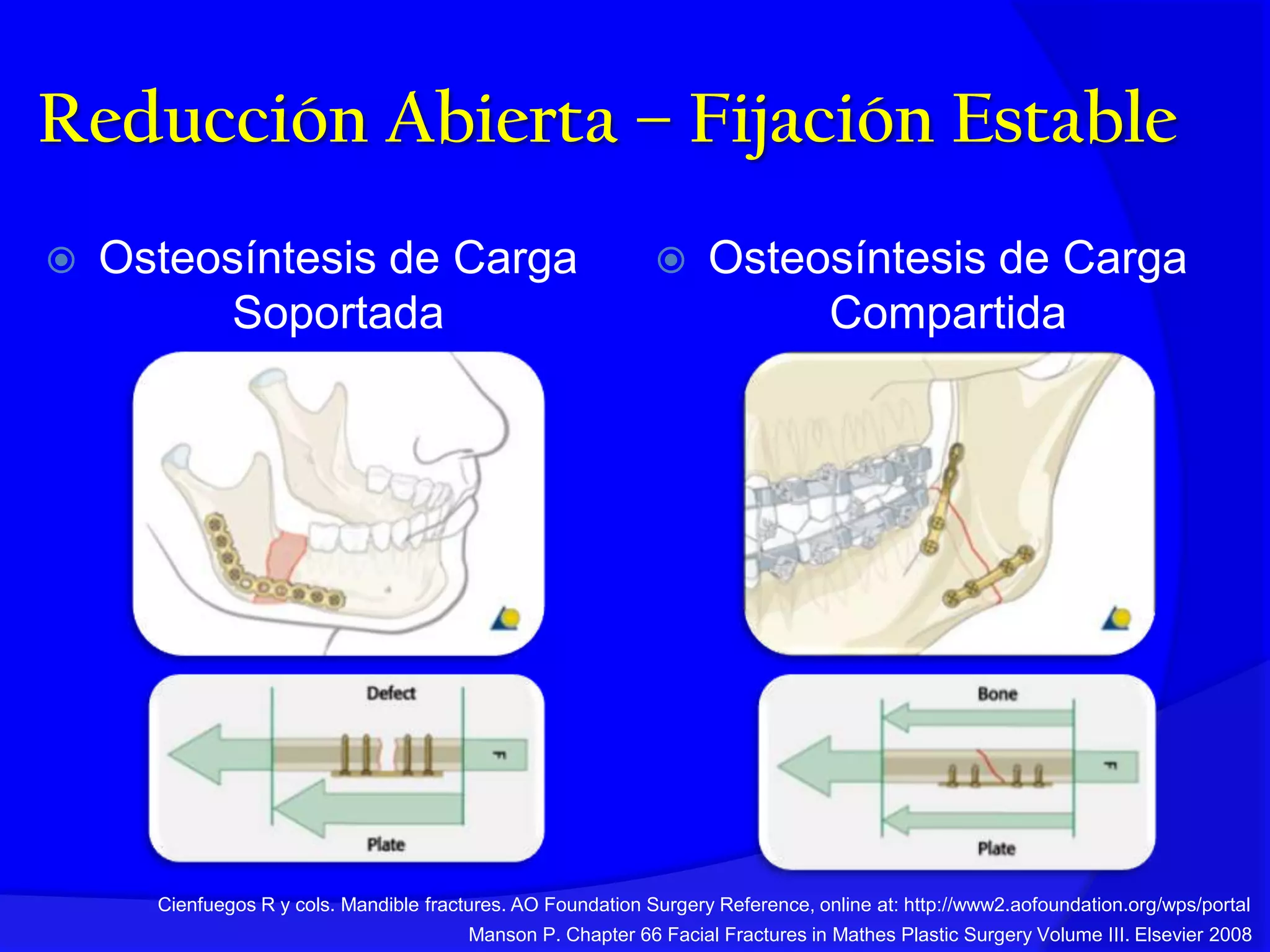 Fracturas de mandibula archivo definitivo | PPTX