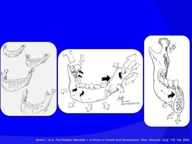 Fracturas de mandibula archivo definitivo | PPTX