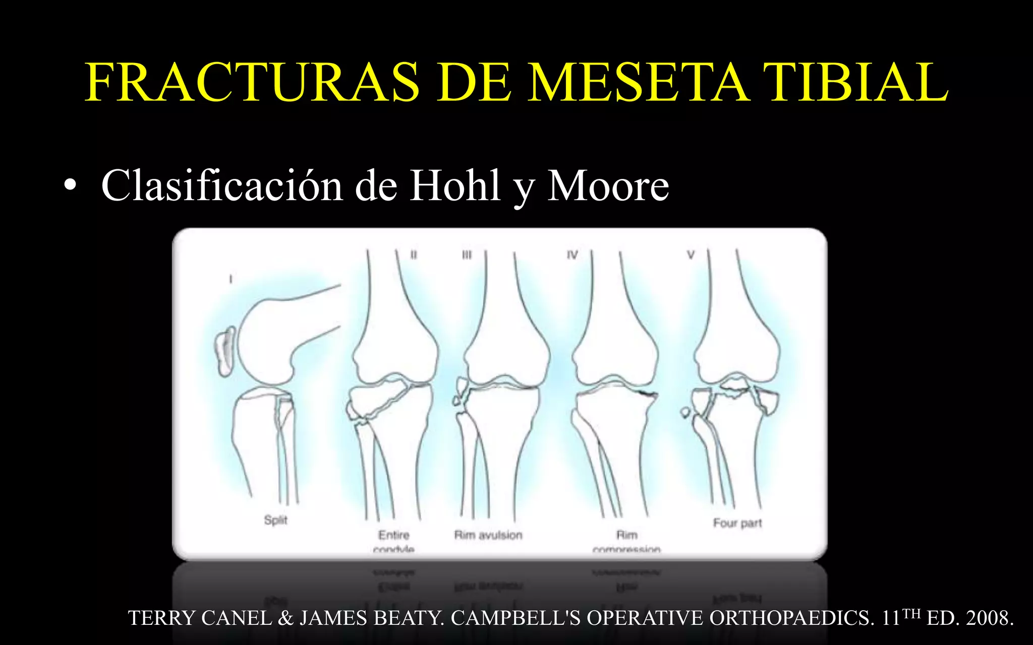 Fracturas De Meseta Tibial Pptx