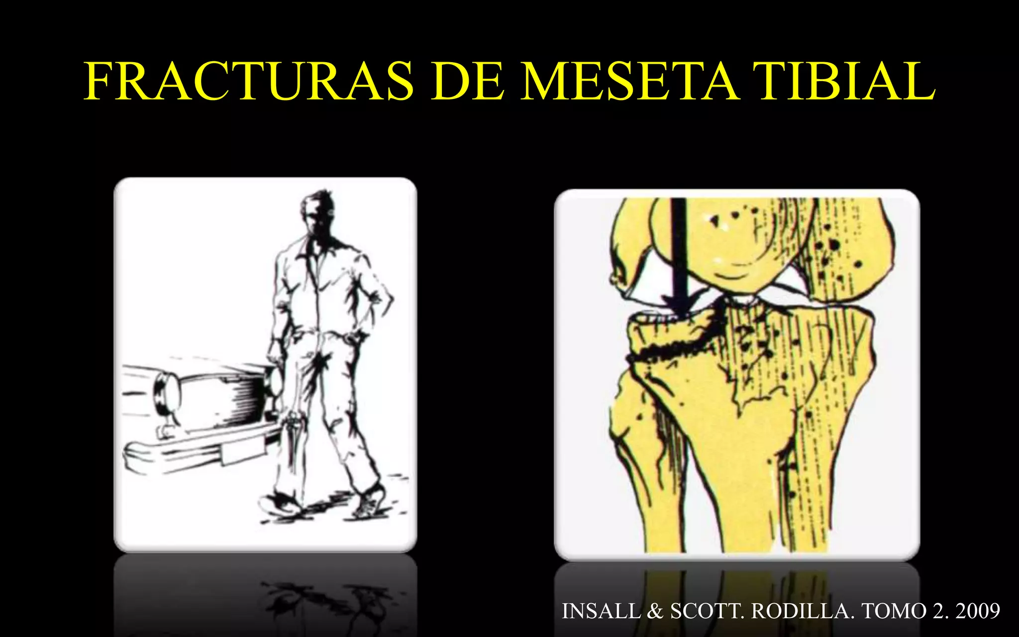 Fracturas De Meseta Tibial Pptx