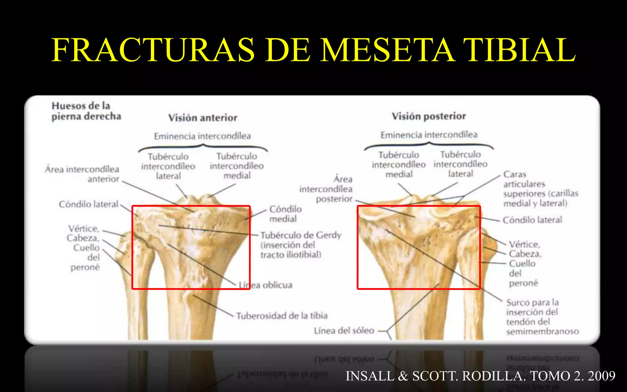 Fracturas De Meseta Tibial Pptx