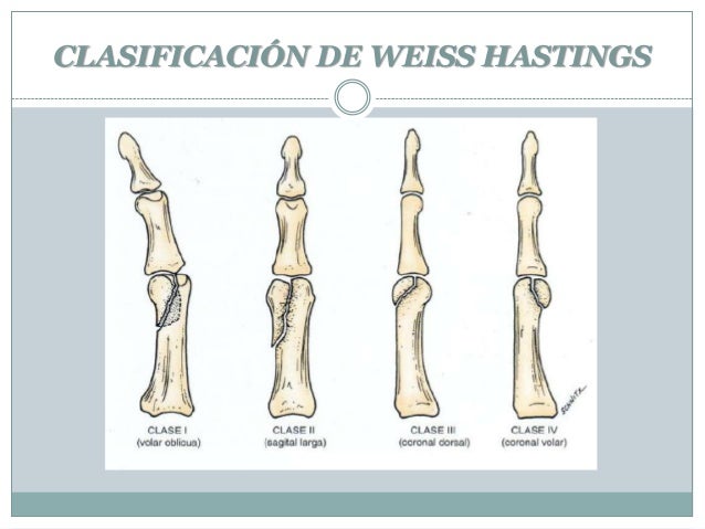 Fracturas de metacarpianos y falanges