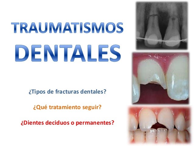 Fracturas Dentales: Todo Lo Que Debes Saber – Chaingang Design