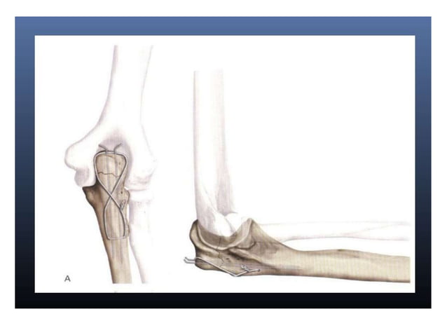 FRACTURAS DE ol de cubito proximal 2420 | PPTX