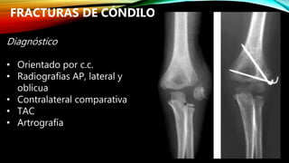 Fracturas de paleta humeral | PPTX