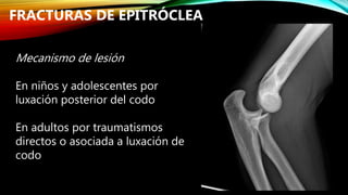 Fracturas de paleta humeral | PPTX