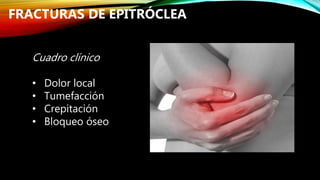 Fracturas de paleta humeral | PPTX