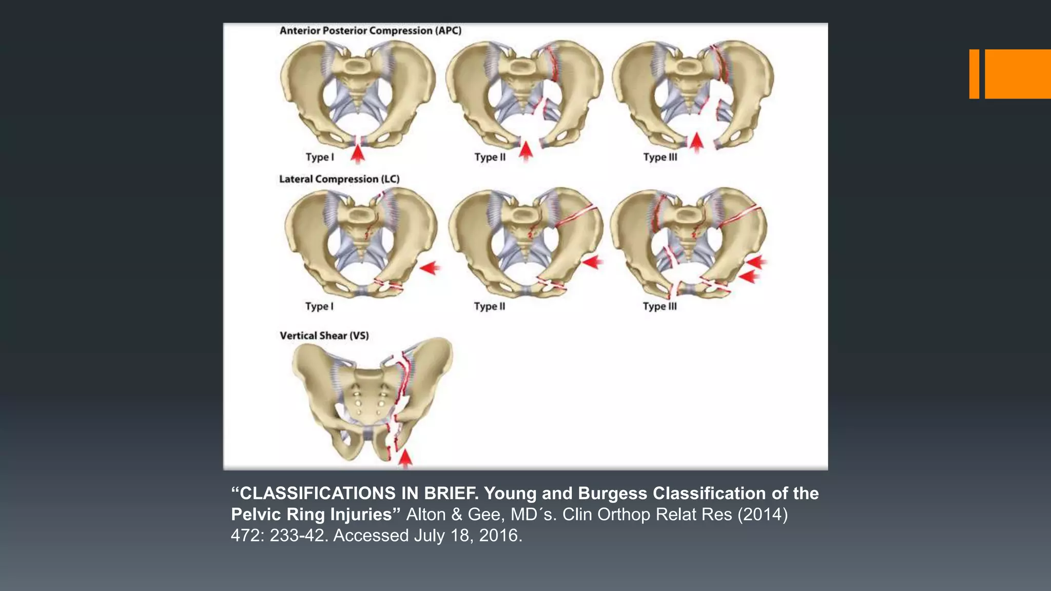 Fracturas de pelvis | PPTX