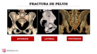 FRACTURAS DE PELVIS - TRAUMATOLOGIAAAAA | PDF