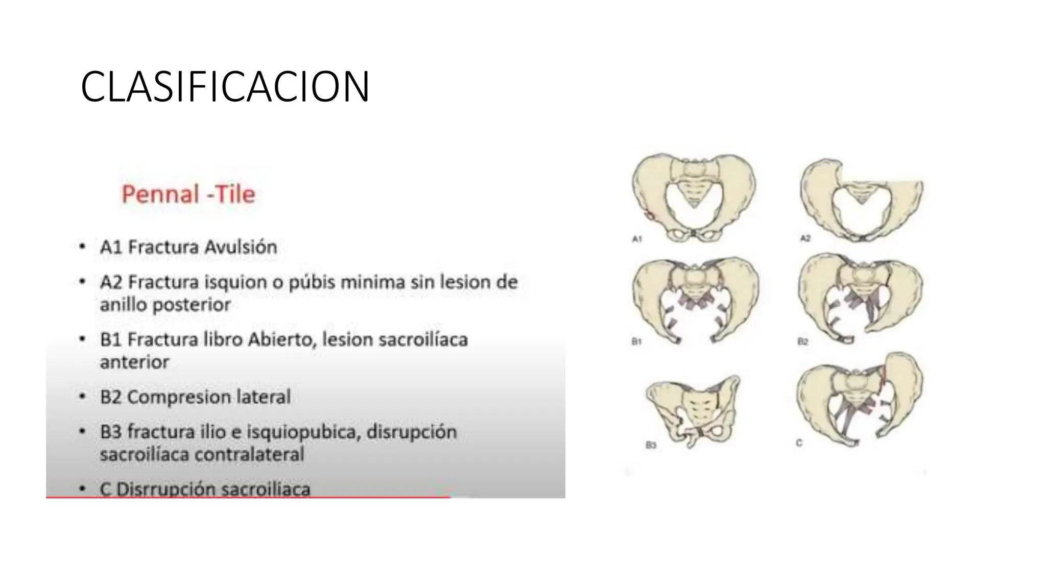 FRACTURAS DE PELVIS EN NIÑOS TRAUMATOLOGIA | PPTX