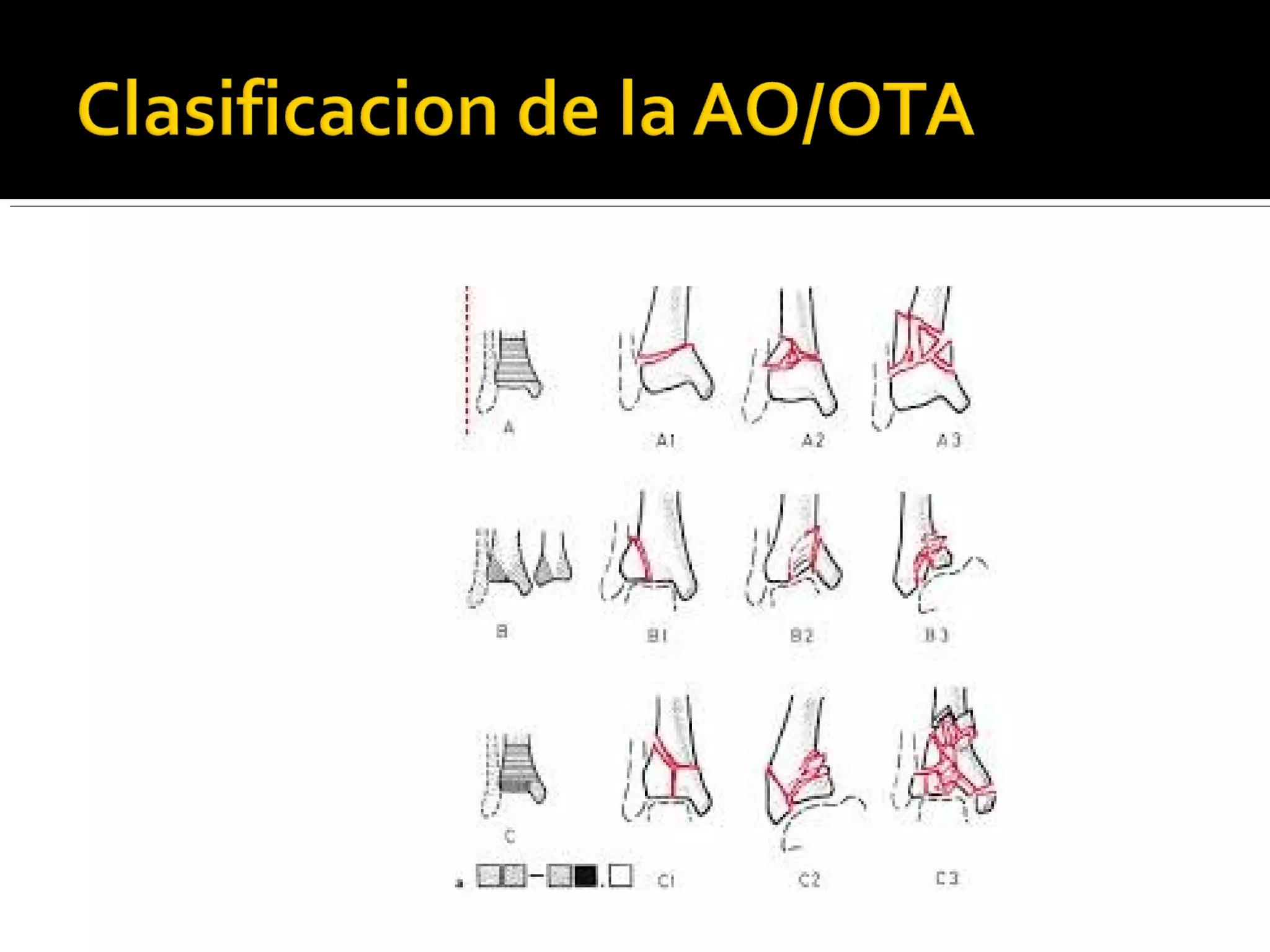 Fracturas de pilon tibial | PPT
