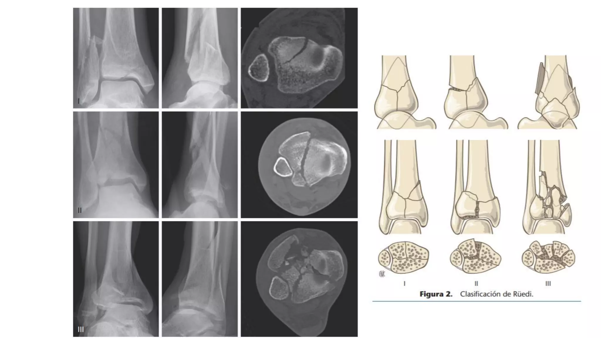 Fracturas de pilon tibial 2020 | PPT