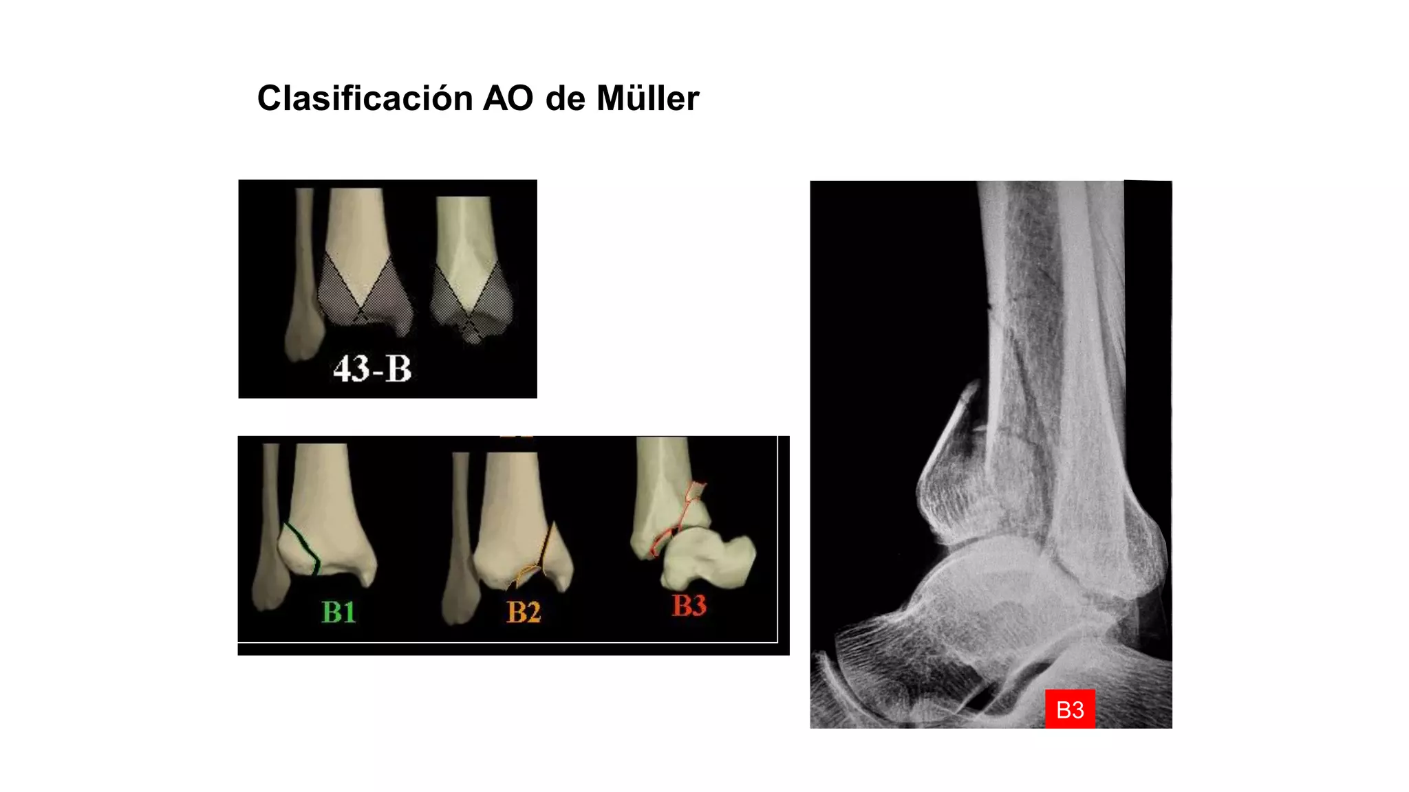 Fracturas de pilon tibial 2020 | PPT