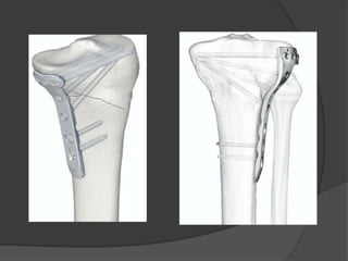 Fracturas de platillo tibial | PPTX