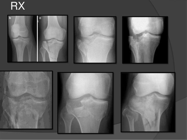 Fracturas de platillo tibial