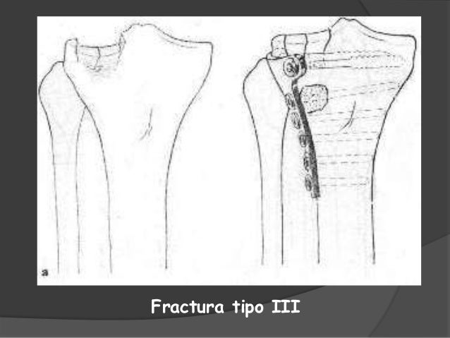 Fracturas de platillo tibial