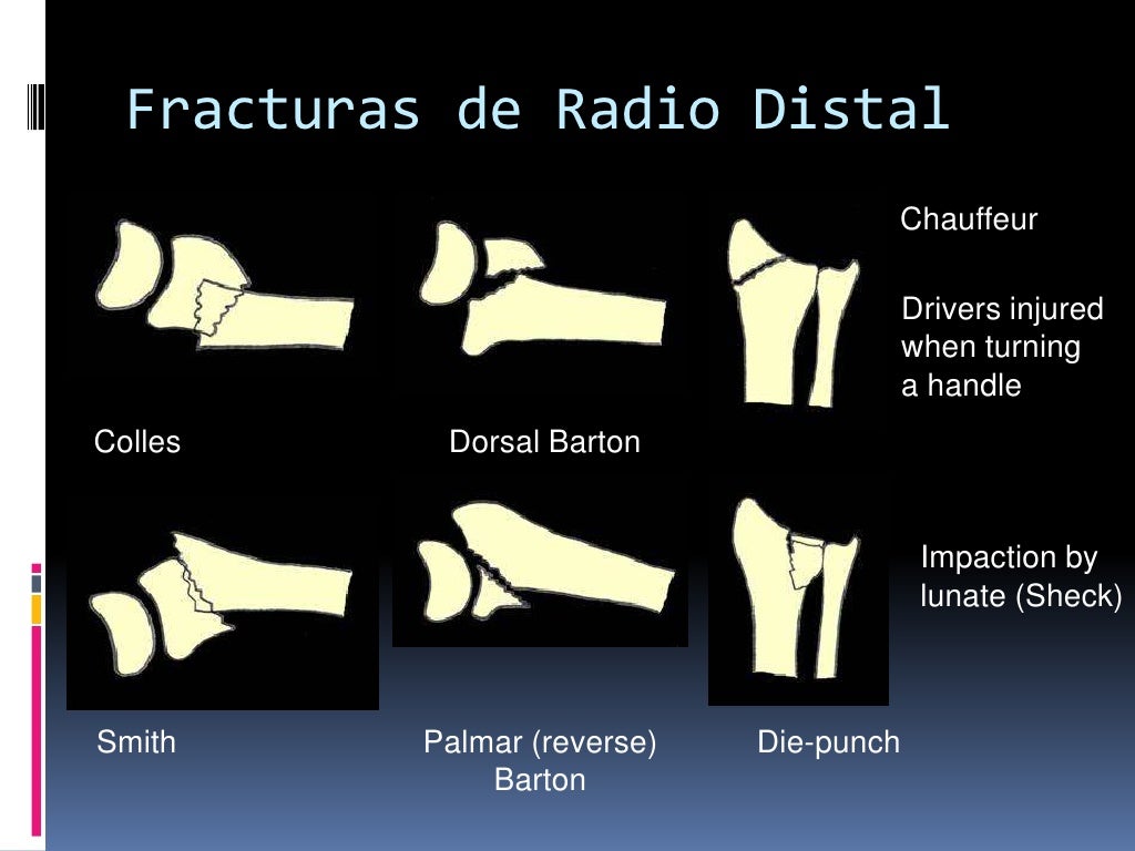 Fracturas Del Tercio Distal De Radio – MRFBK
