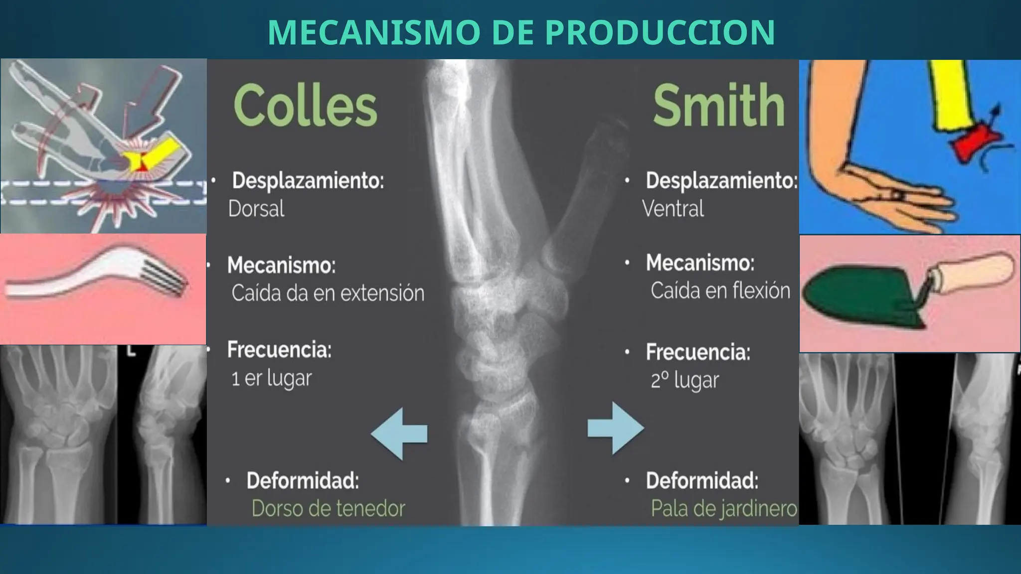 FRACTURAS DE hueso RADIO DISTAL, antbrazo | PPT