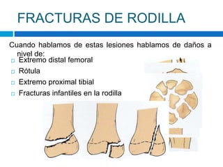 Fracturas de rodilla | PPTX
