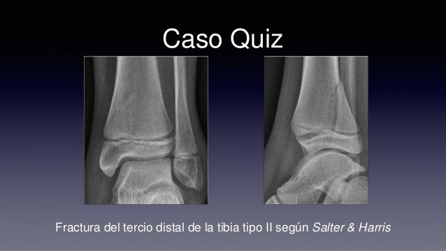 Fracturas de Salter & Harris