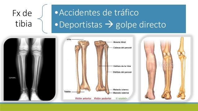 Fracturas de tibia
