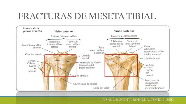 Fracturas de tibia