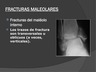 Fracturas trauma de Tibia, Peroné y Pie.ppt