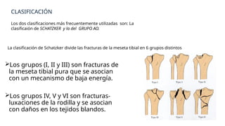Fracturas De Tibial Proximal Meseta Pptx