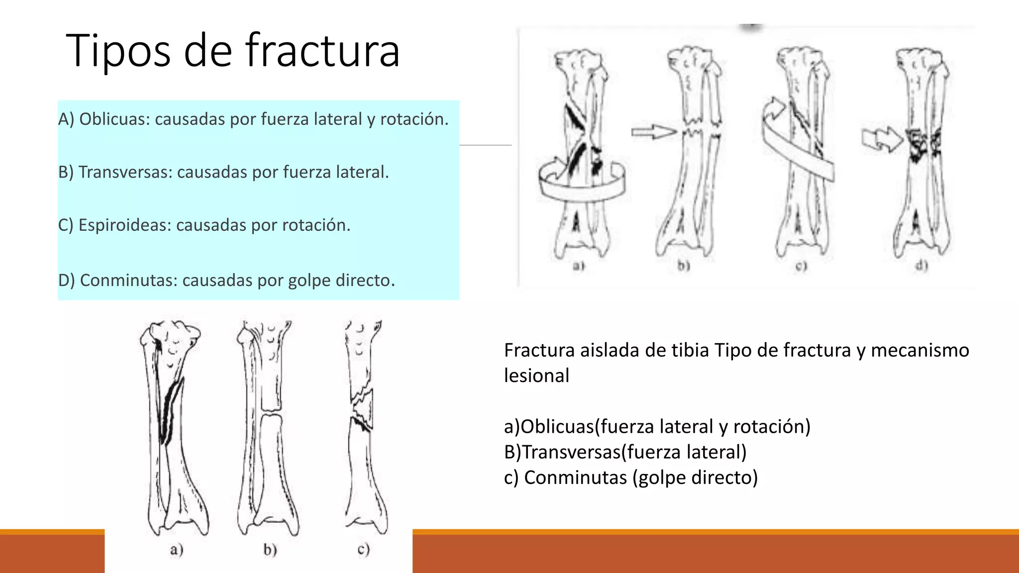 Fracturas de tibia y perone | PPTX