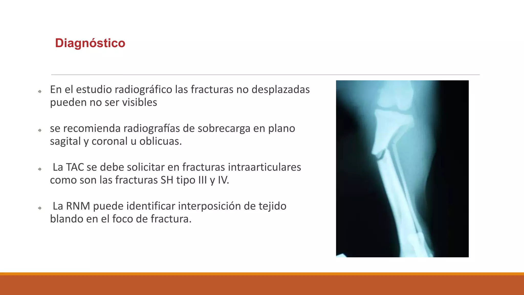 Fracturas de tibia y perone | PPTX