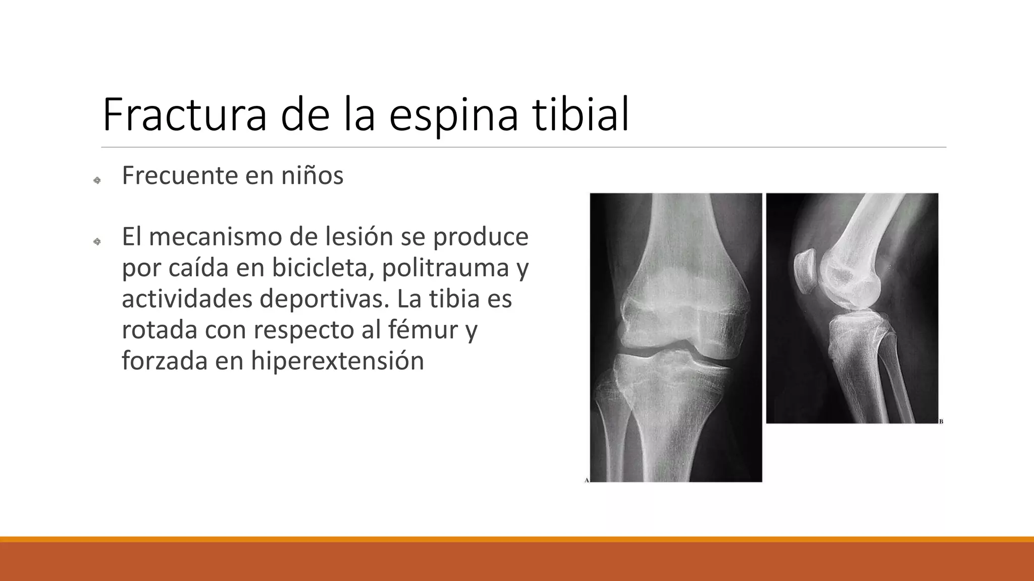 Fracturas de tibia y perone | PPTX