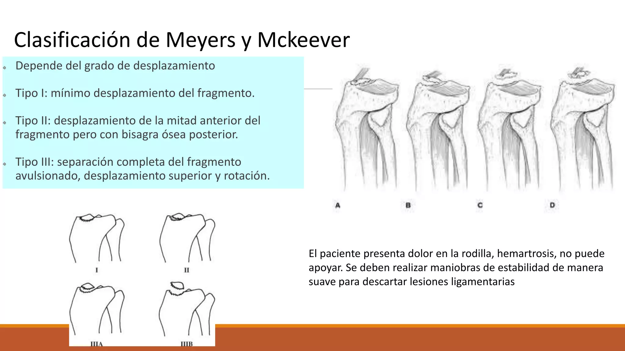 Fracturas de tibia y perone | PPTX