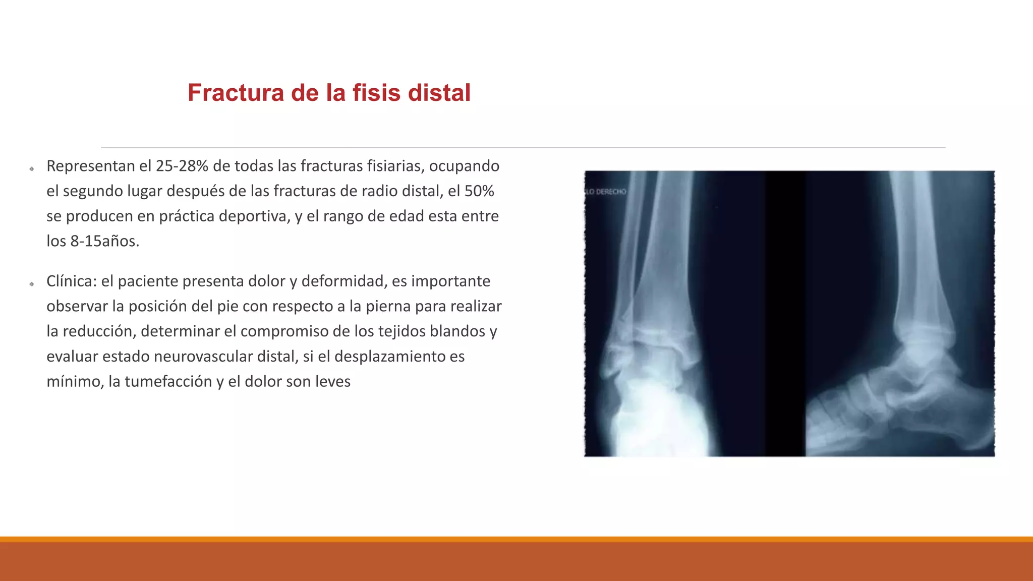 Fracturas de tibia y perone | PPTX