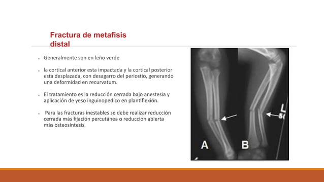 Fracturas de tibia y perone | PPTX