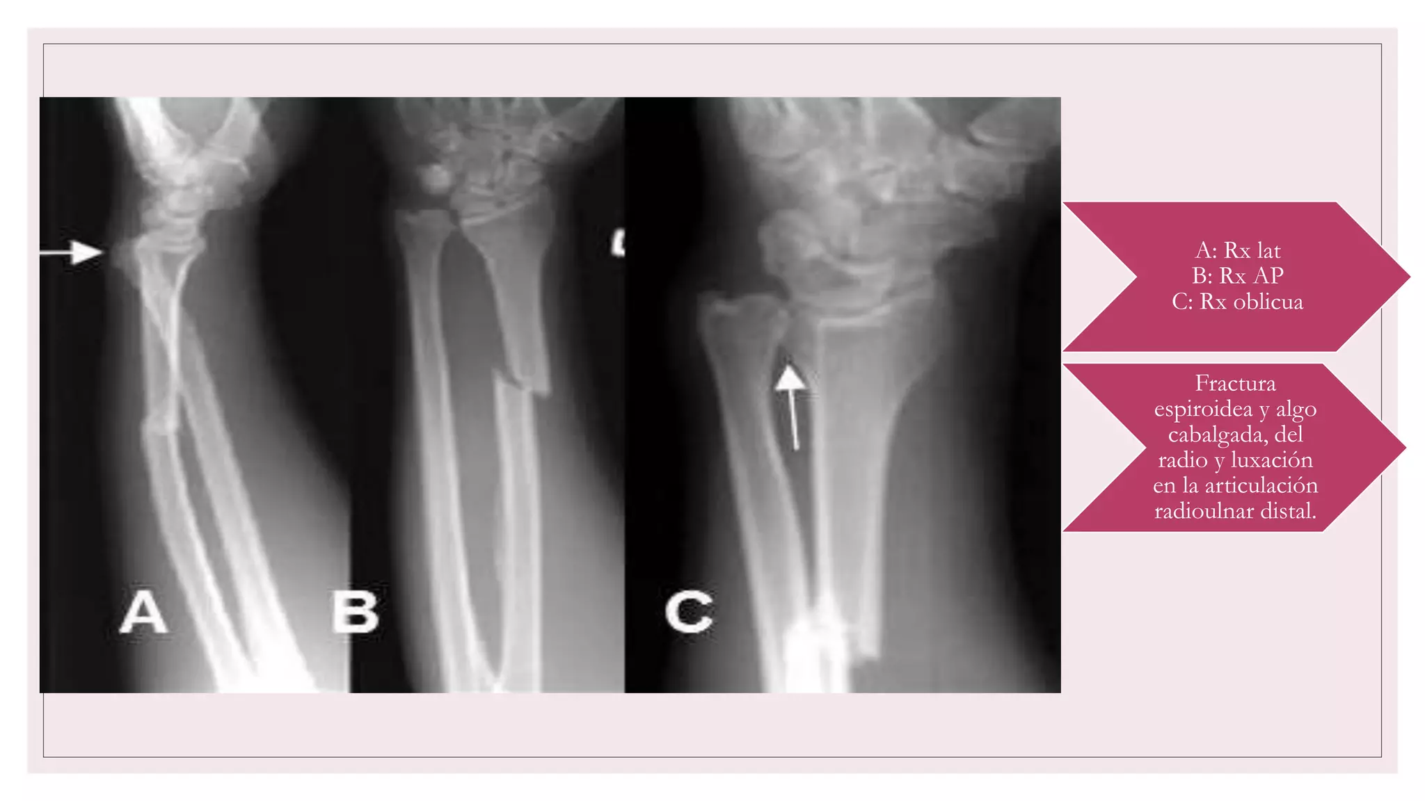 Fracturas diafisarias de cubito y radio | PPTX