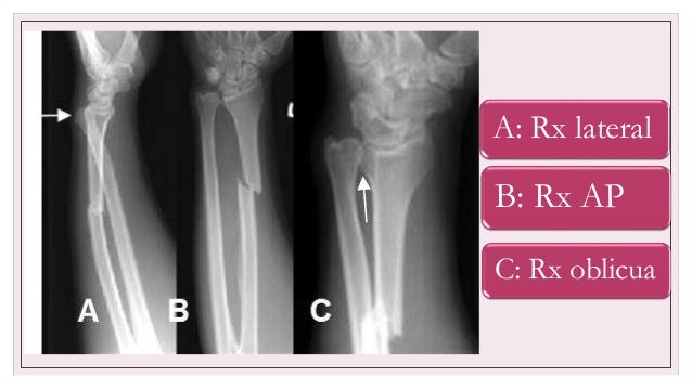 Fracturas diafisarias de cubito y radio