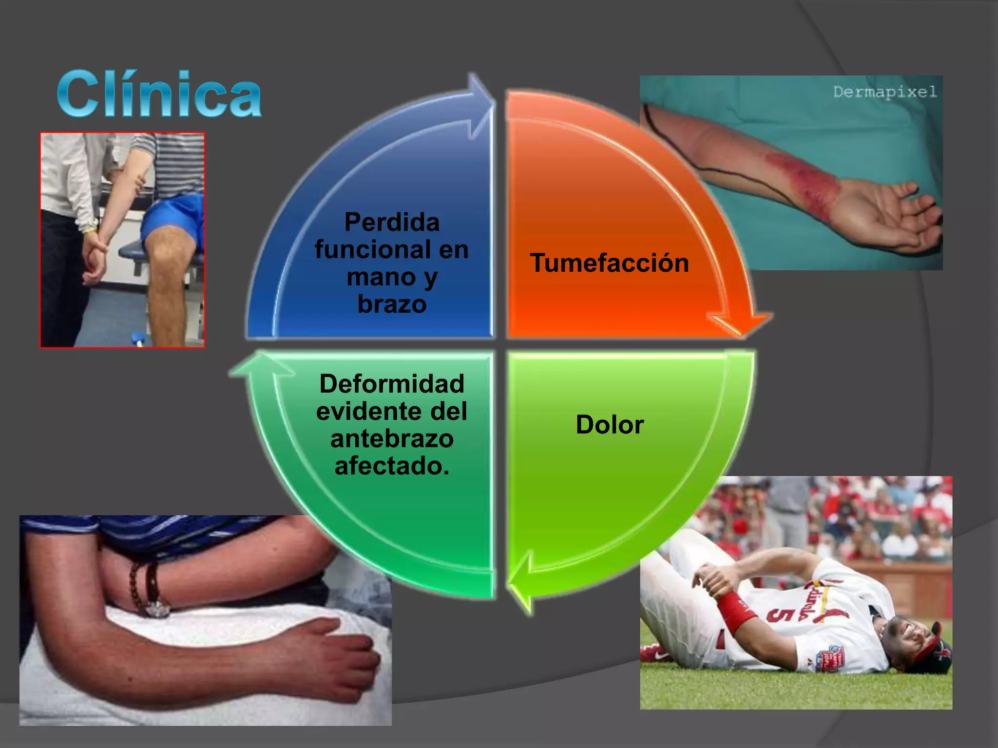 Fracturas Diafisarias de Cubito y Radio. | PPTX