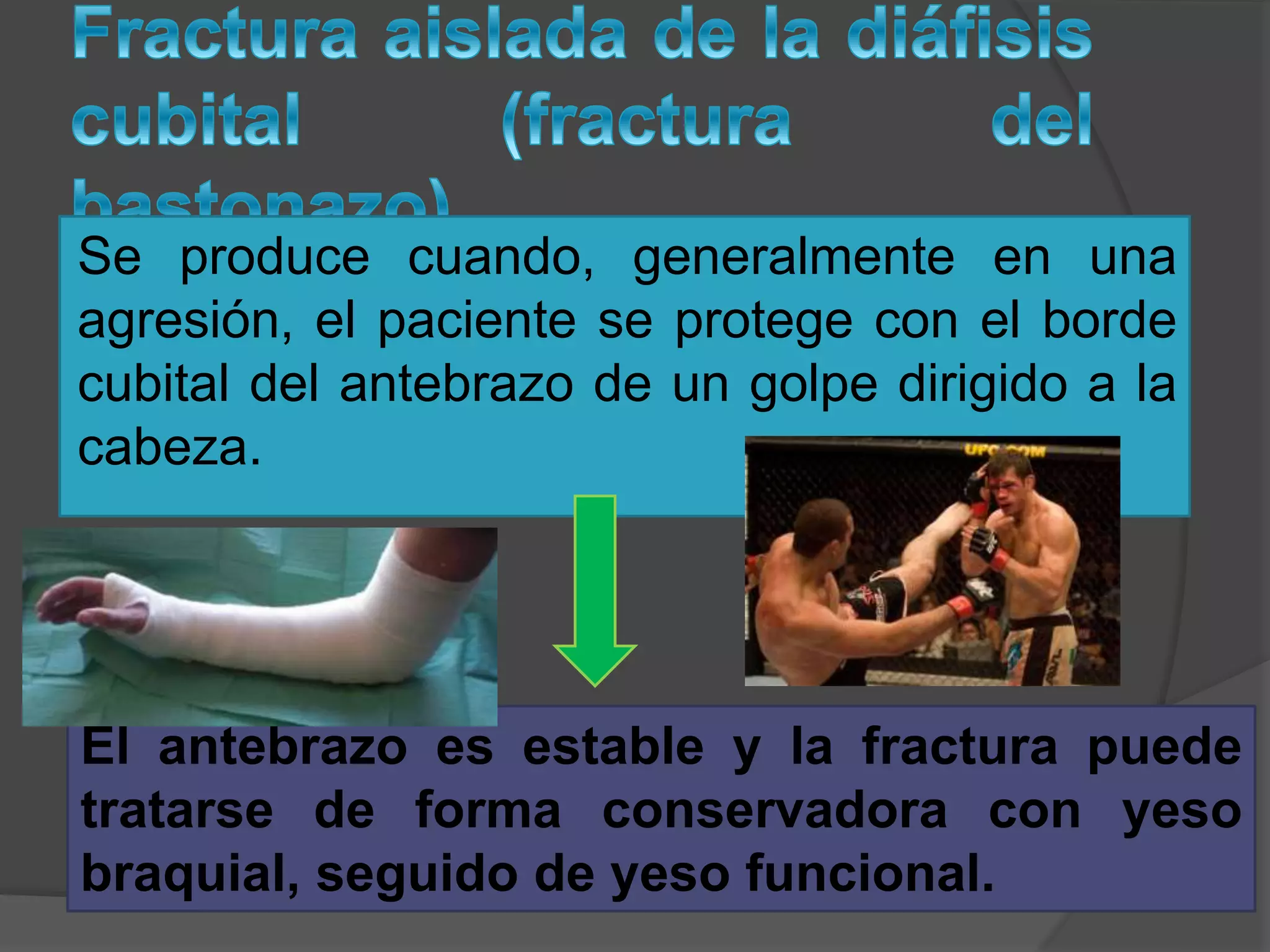 Fracturas Diafisarias de Cubito y Radio. | PPTX