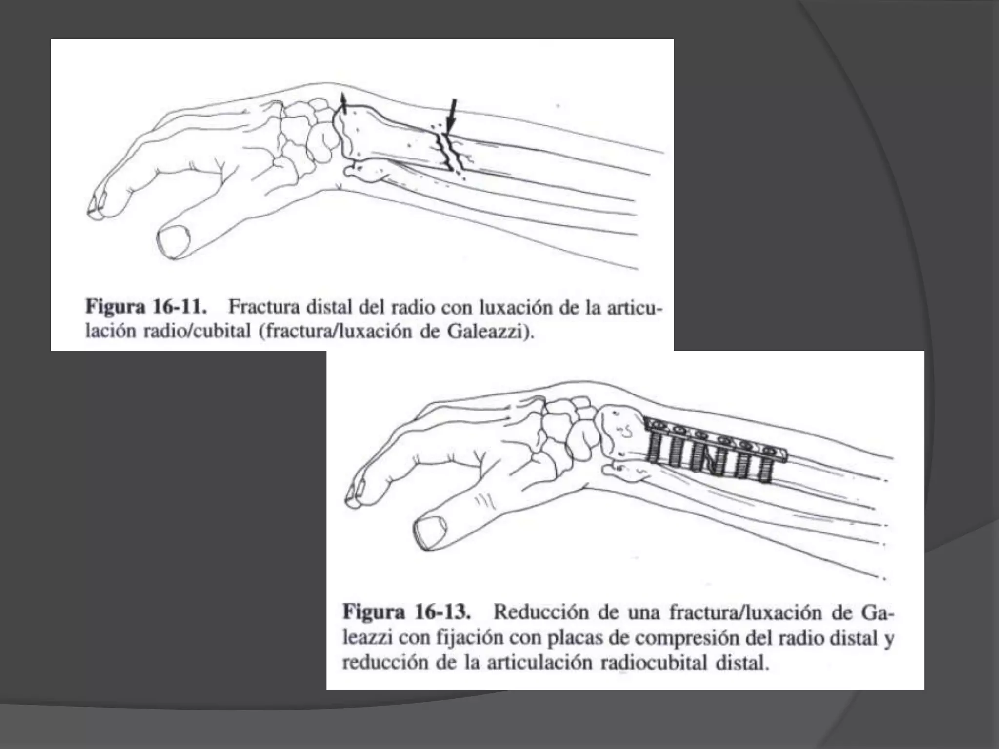 Fracturas Diafisarias de Cubito y Radio. | PPTX