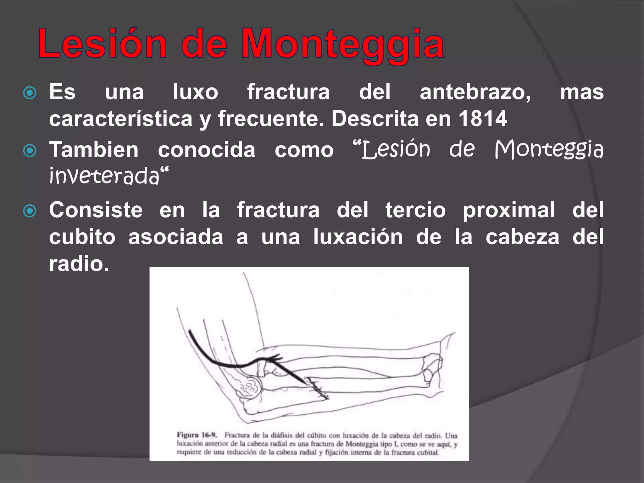 Fracturas Diafisarias de Cubito y Radio. | PPTX