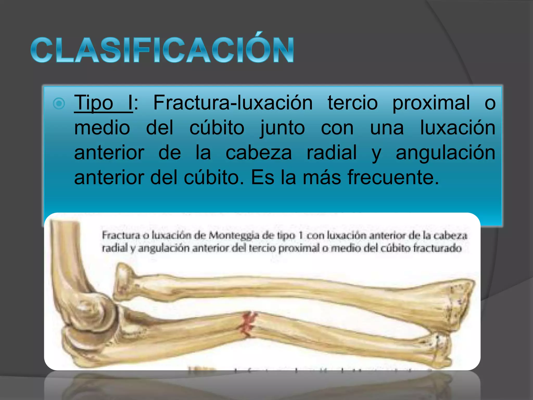 Fracturas Diafisarias de Cubito y Radio. | PPTX