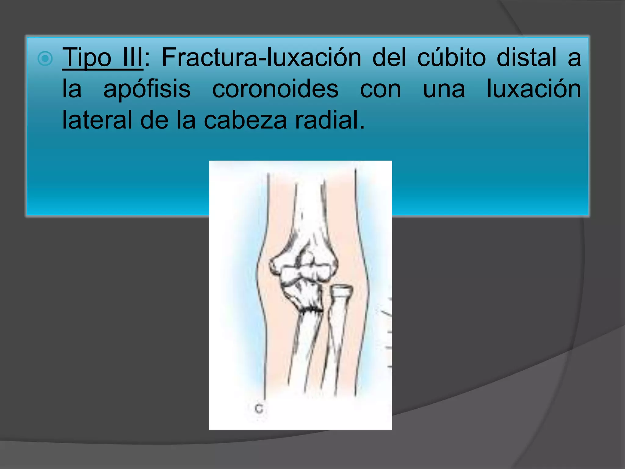 Fracturas Diafisarias de Cubito y Radio. | PPTX
