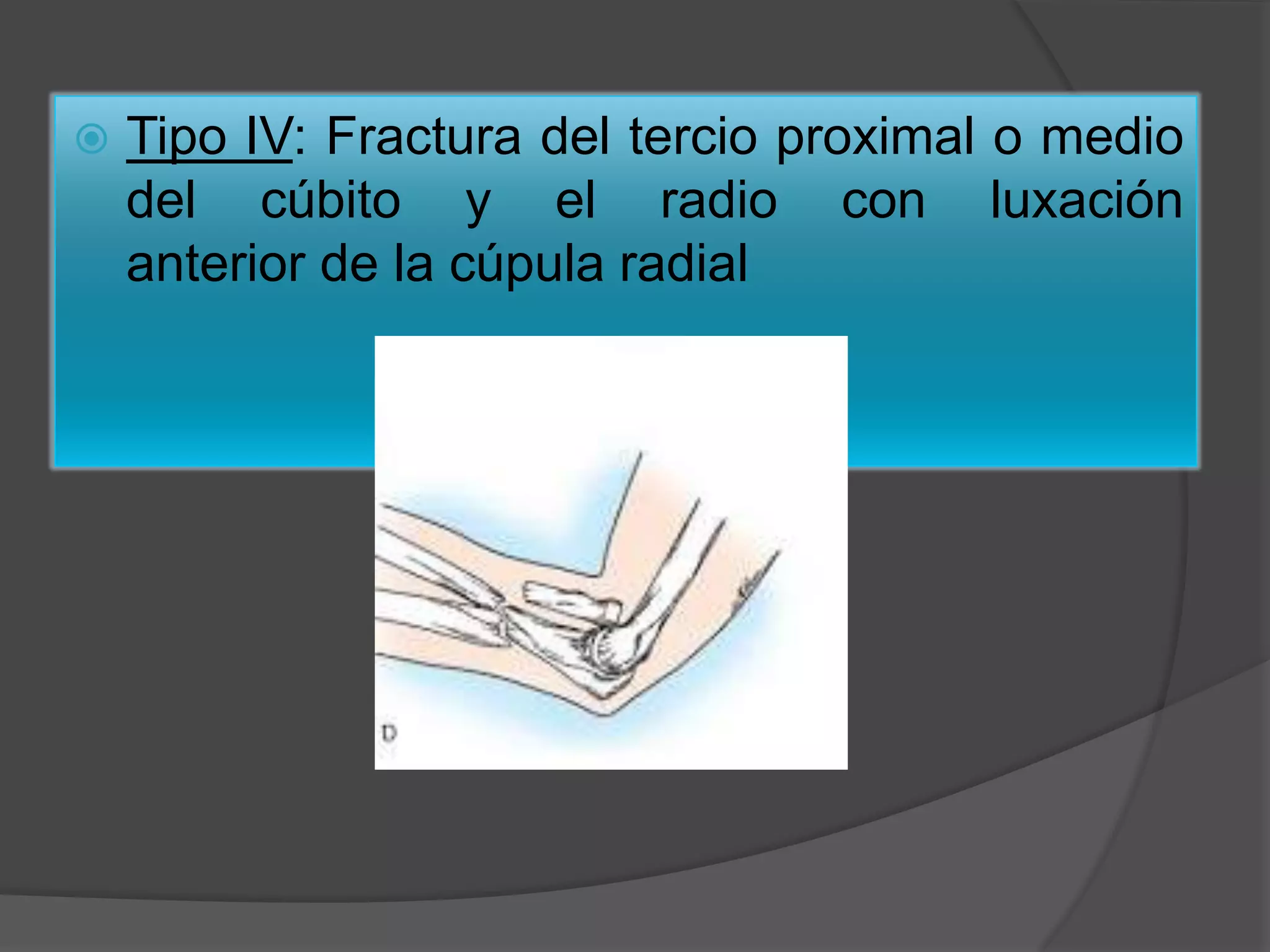 Fracturas Diafisarias de Cubito y Radio. | PPTX