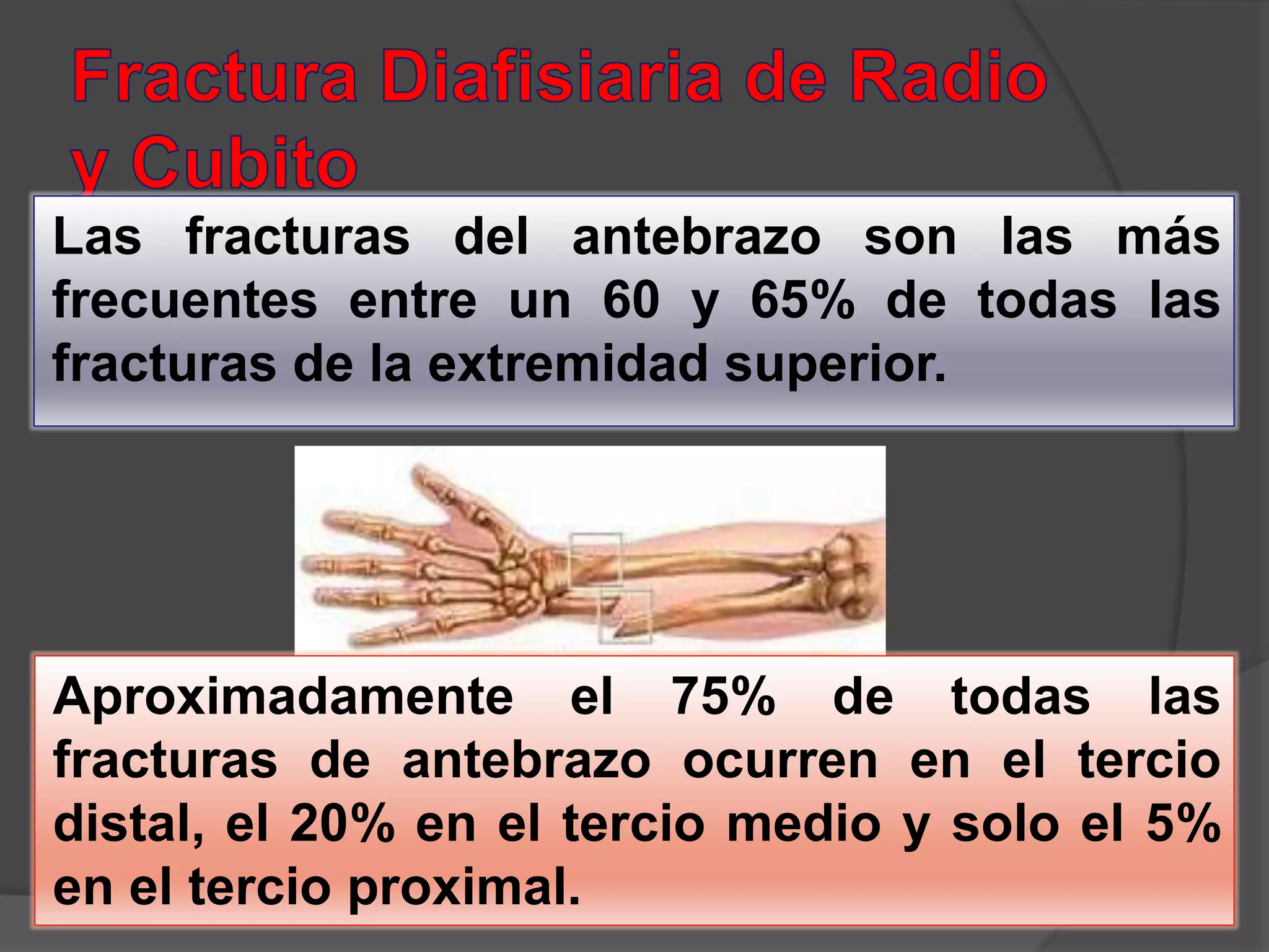 Fracturas Diafisarias de Cubito y Radio. | PPTX