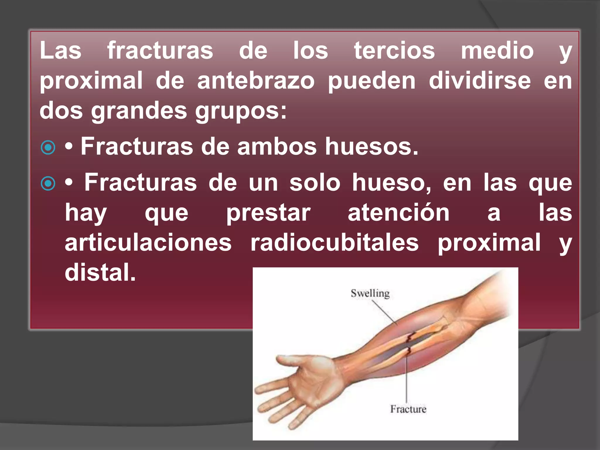 Fracturas Diafisarias de Cubito y Radio. | PPTX