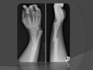 Fracturas Diafisarias de Cubito y Radio. | PPTX