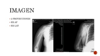 FRACTURAS DIAFISIARIAS DE HÚMERO.pptx