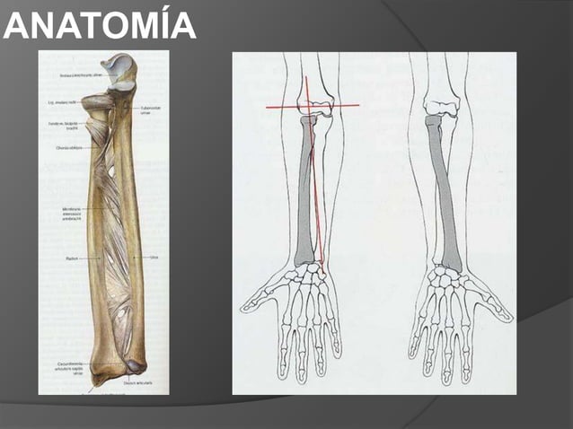 Fracturas diafisiarias y tercio distal de radio y cubito