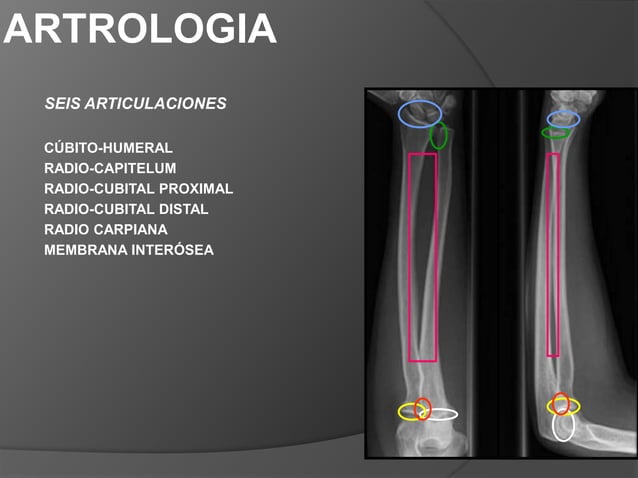 Fracturas diafisiarias y tercio distal de radio y cubito | PPT
