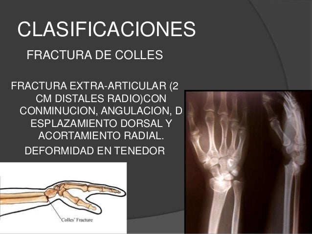 Fracturas diafisiarias y tercio distal de radio y cubito